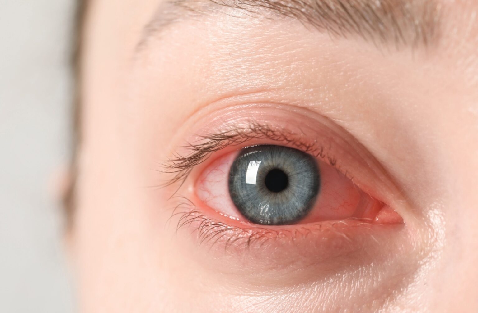 Can High Blood Pressure Cause Red Eyes? | Chula Vista